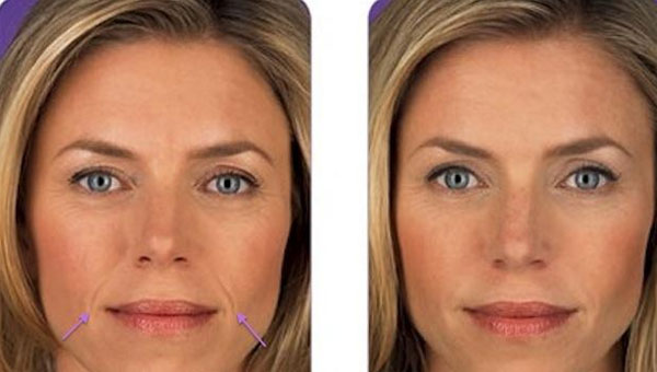 Acide hyaluronique pommette - Dulcifluous